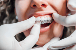 Invisalign Reviews (2023): The Good, Bad & Ugly Reality